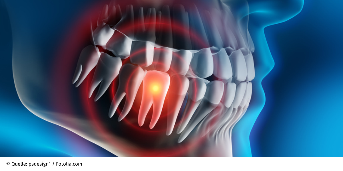 Karies: Diese Behandlungsmöglichkeiten gibt es | Verbraucherzentrale.de